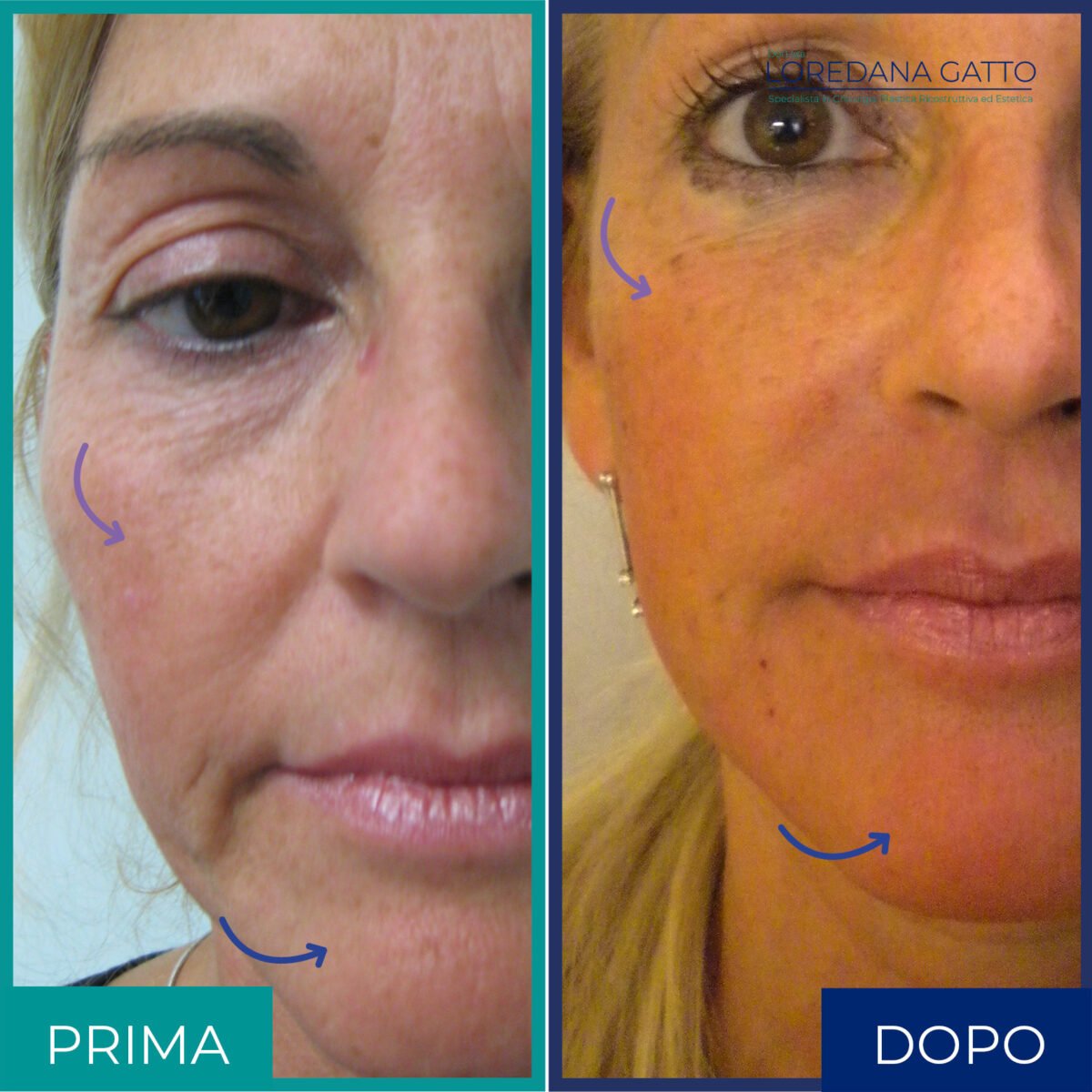 Filler all’acido ialuronico per rimodellare il mento - Chirurgia ...